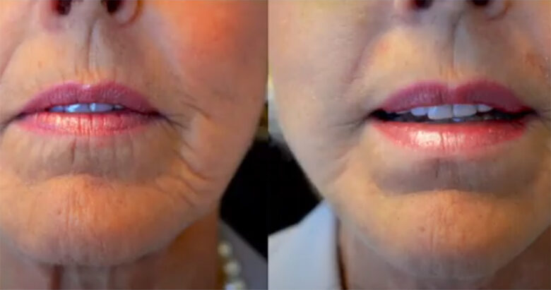 AngelLift: What Happened After Shark Tank - SharkTankWiki